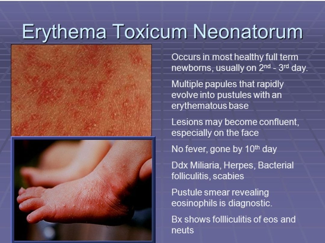 Erythema Toxicum