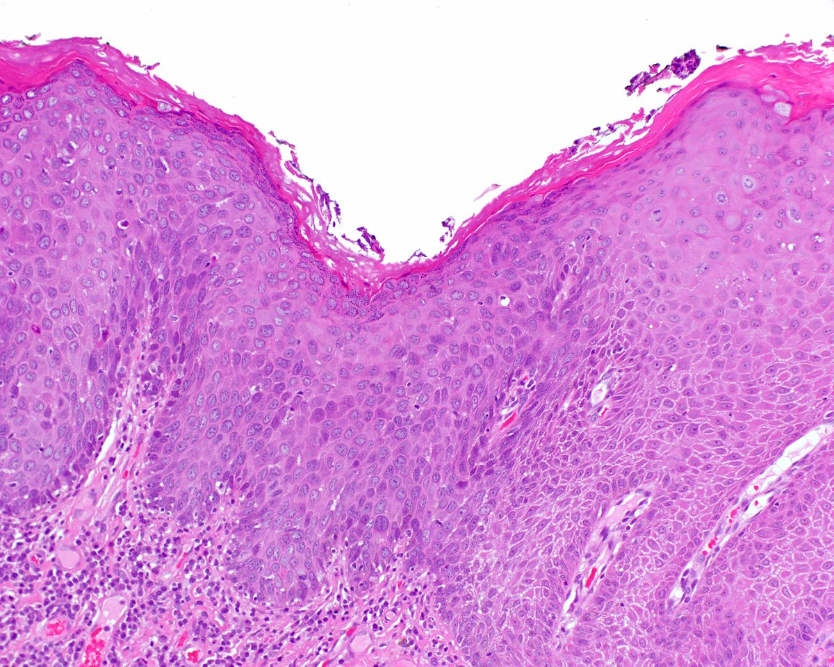 Elizabeth Montgomery, MD on Twitter: "Cool case. The mitosoid bodies seem to be in the LSIL zone ...