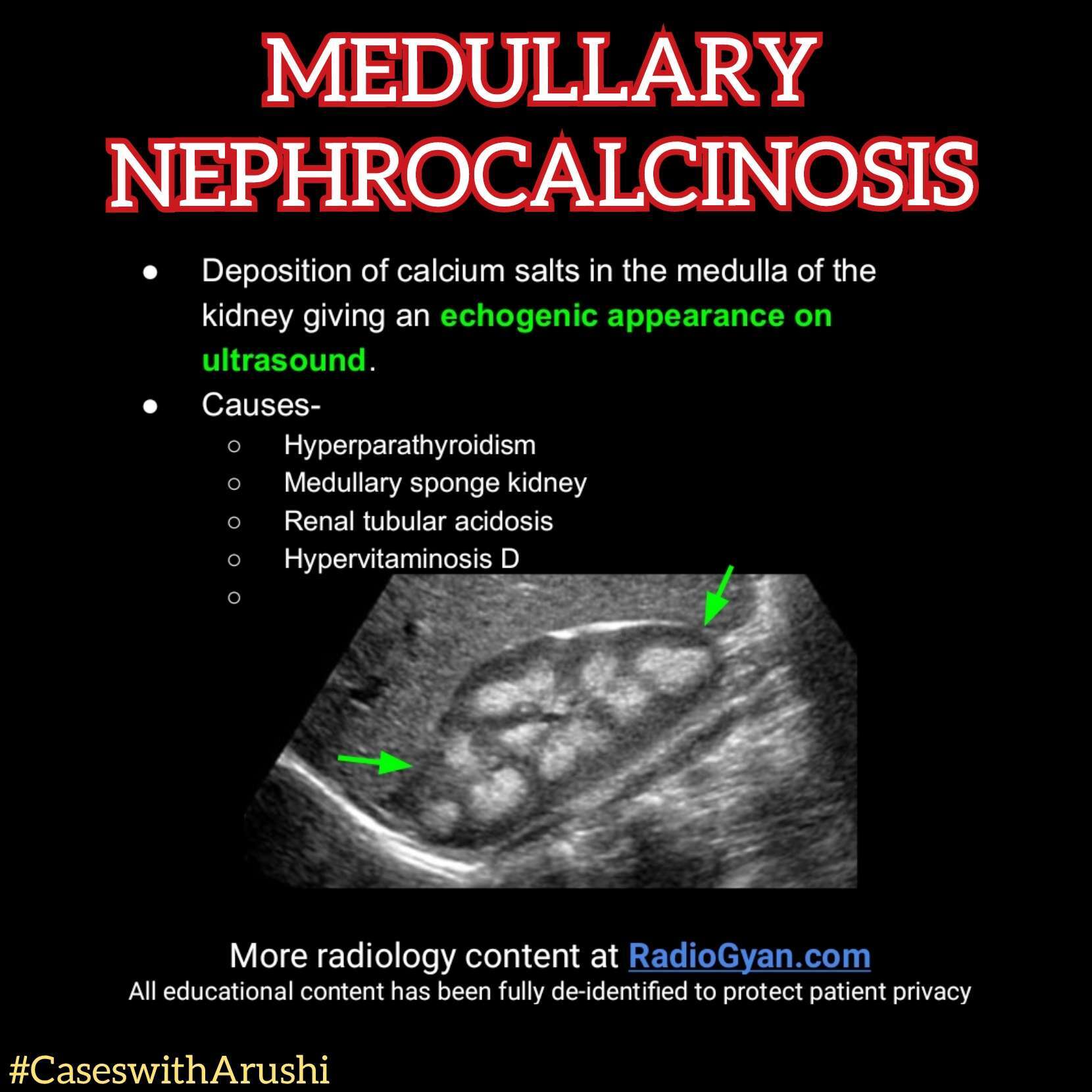 Medullary Sponge Kidney