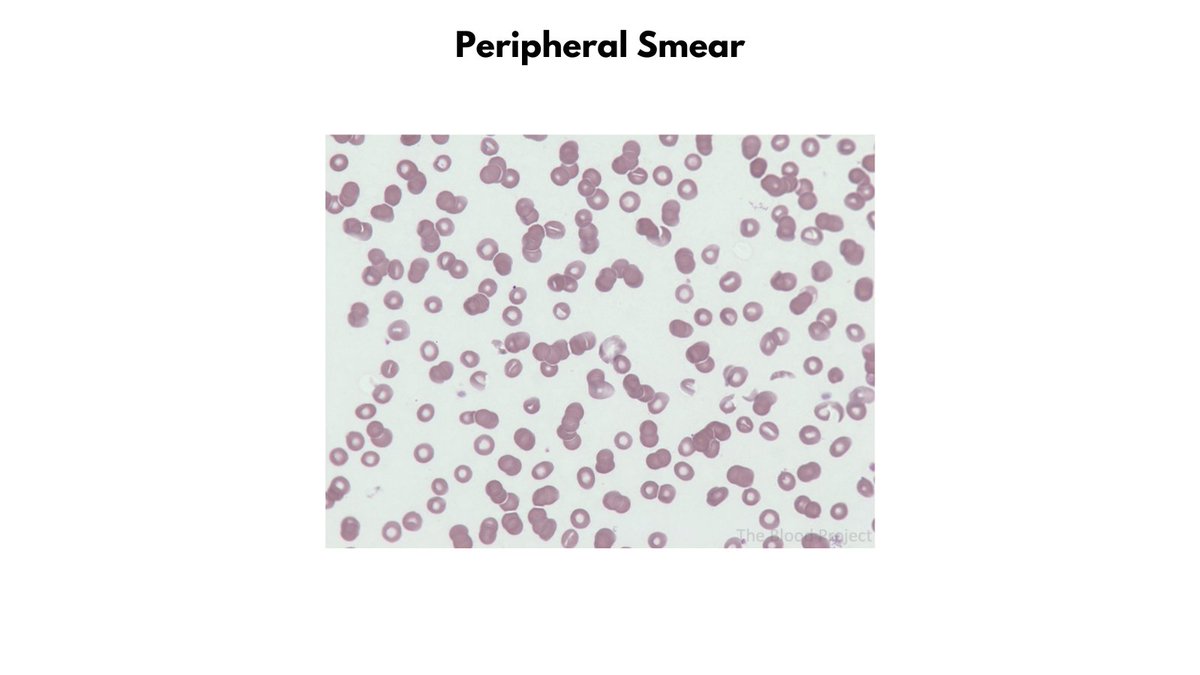 1/8 PERIPHERAL SMEAR QUESTION: Check out the peripheral smear (low ...