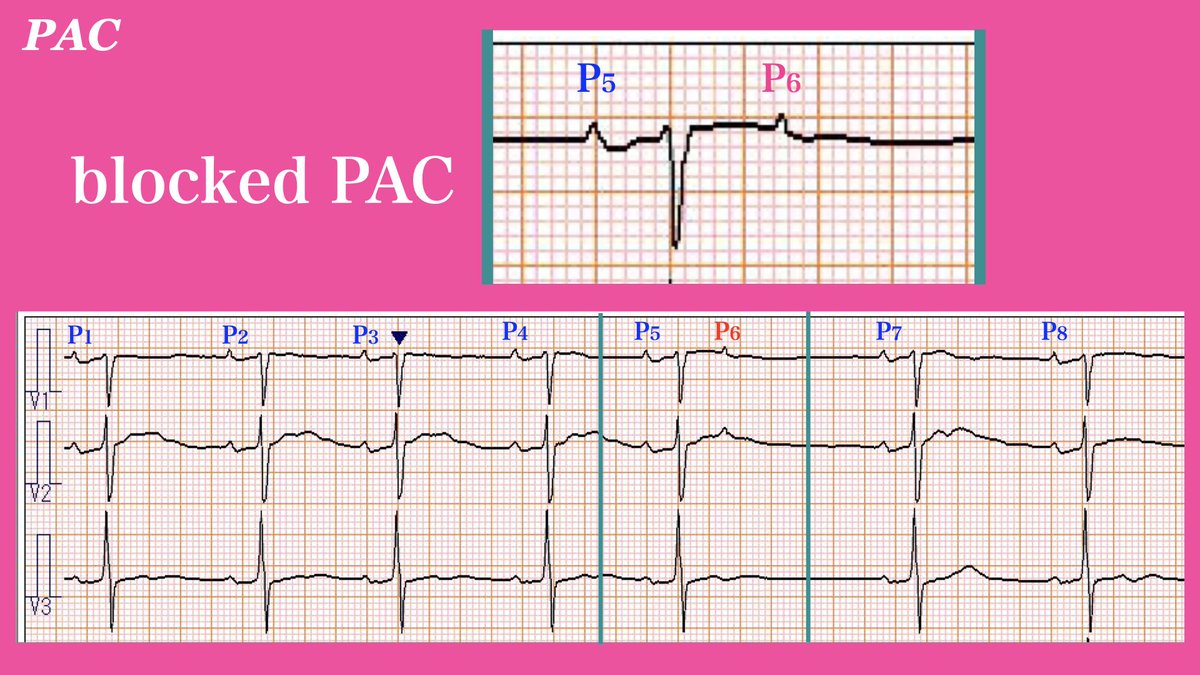 N. Tsukishima EP大学心電図検定学部試験対策科担任 on Twitter: "#YellowPAC-020 P on TのPAC症例です。 P’(P6)の出現が早すぎると、房室 ...