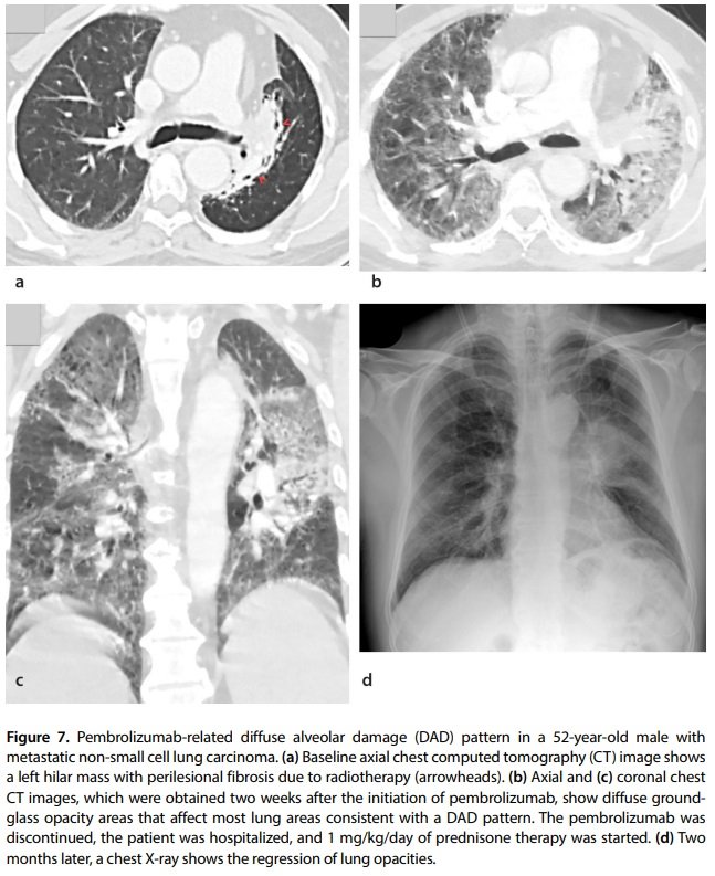 I am pleased to announce that our newest review article (Drug-induced ...