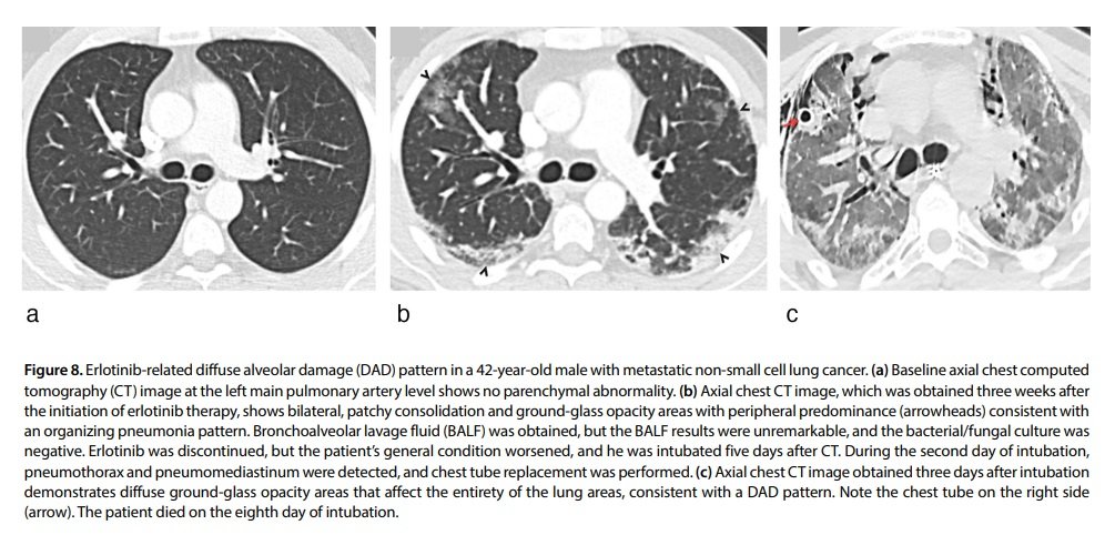 I am pleased to announce that our newest review article (Drug-induced ...