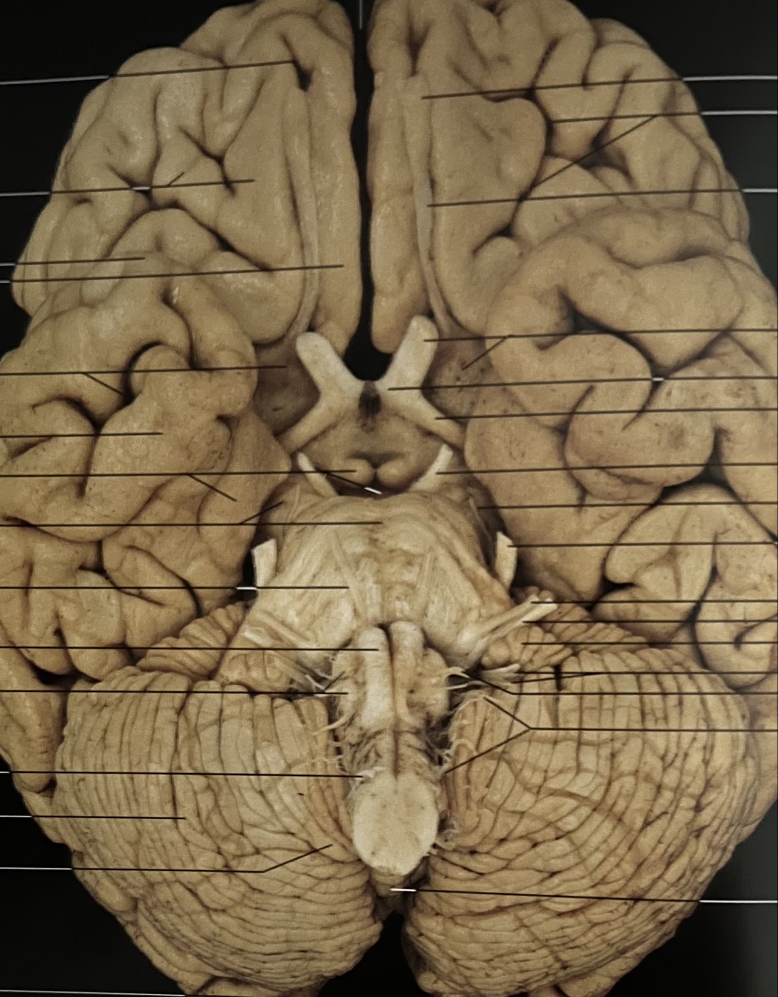 Cranial Nerves Brain Cadaver