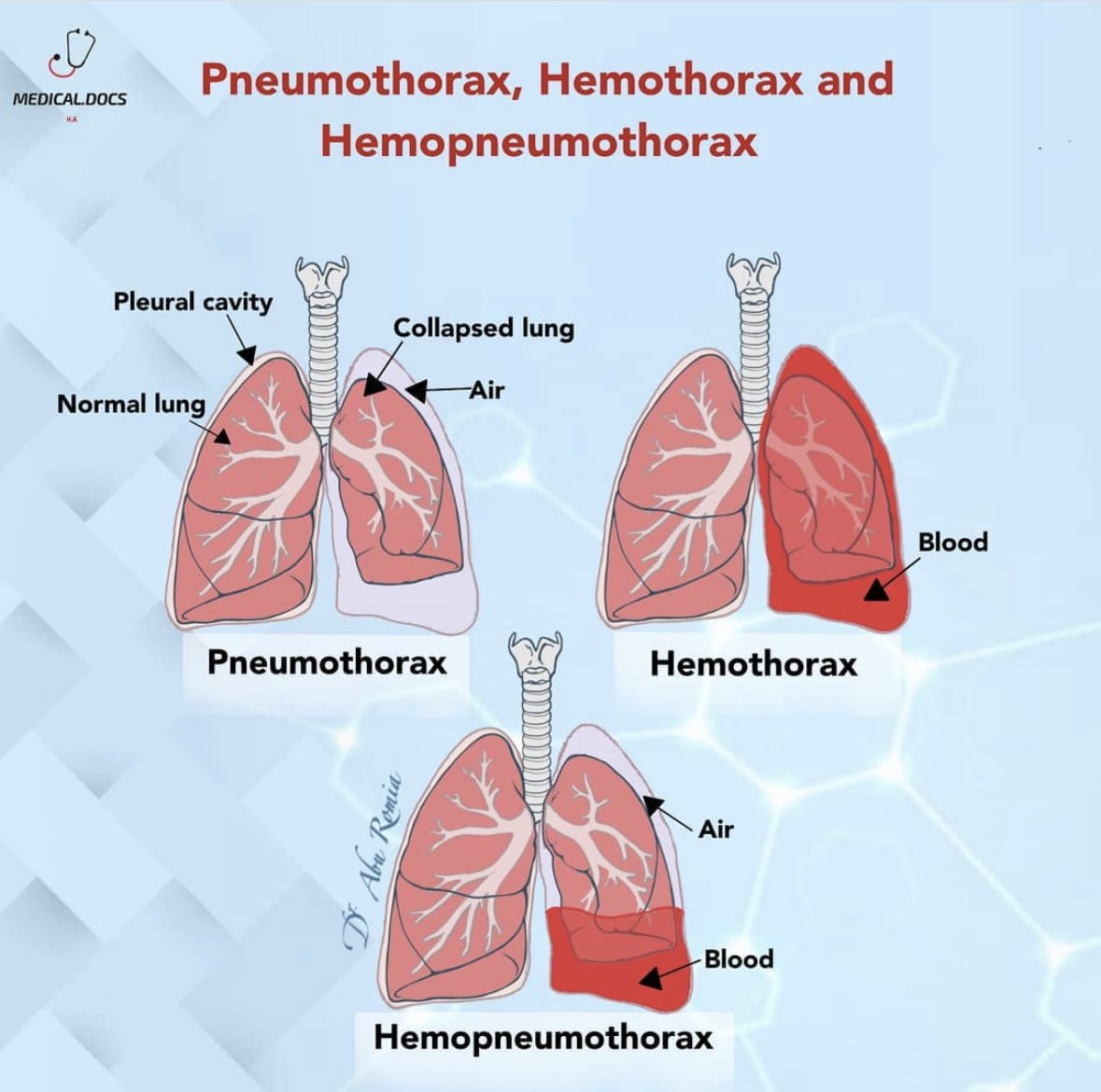 Picture Pneumothorax Hemothorax
