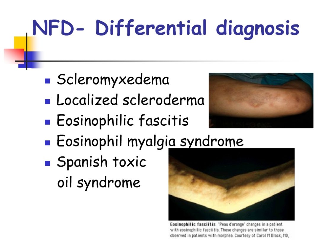 Nephrogenic Fibrosing Dermopathy