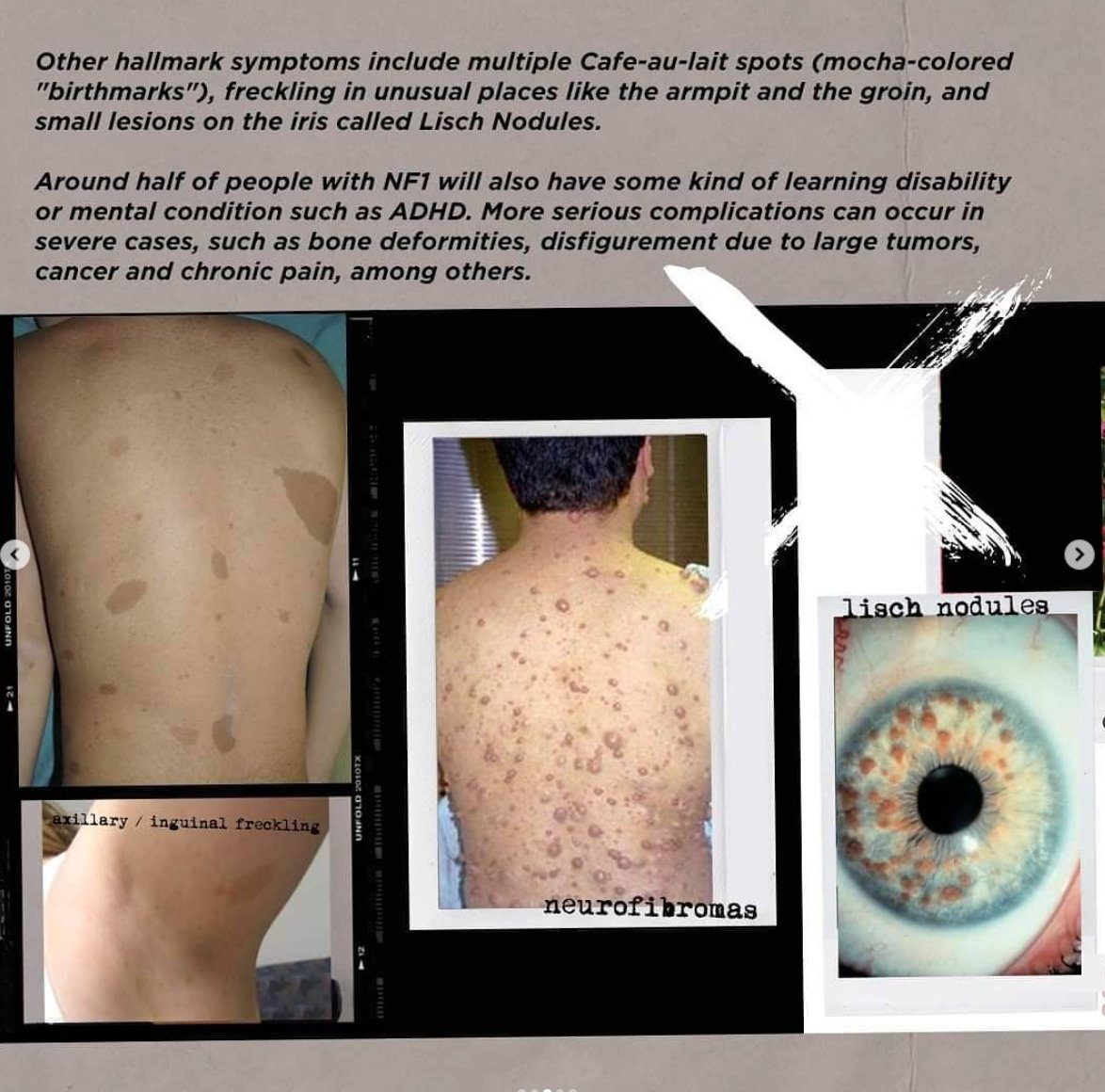 Axillary And Inguinal Freckling