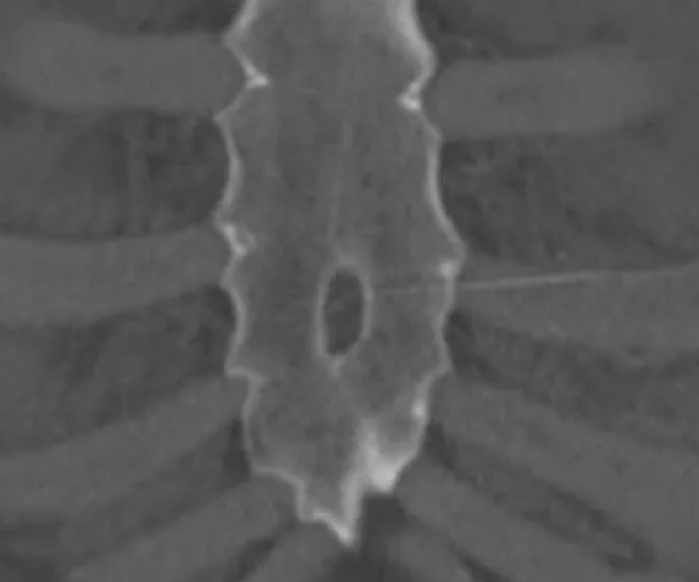 Radrounds Radiology Network On Twitter Normal Or Abnormal Answer