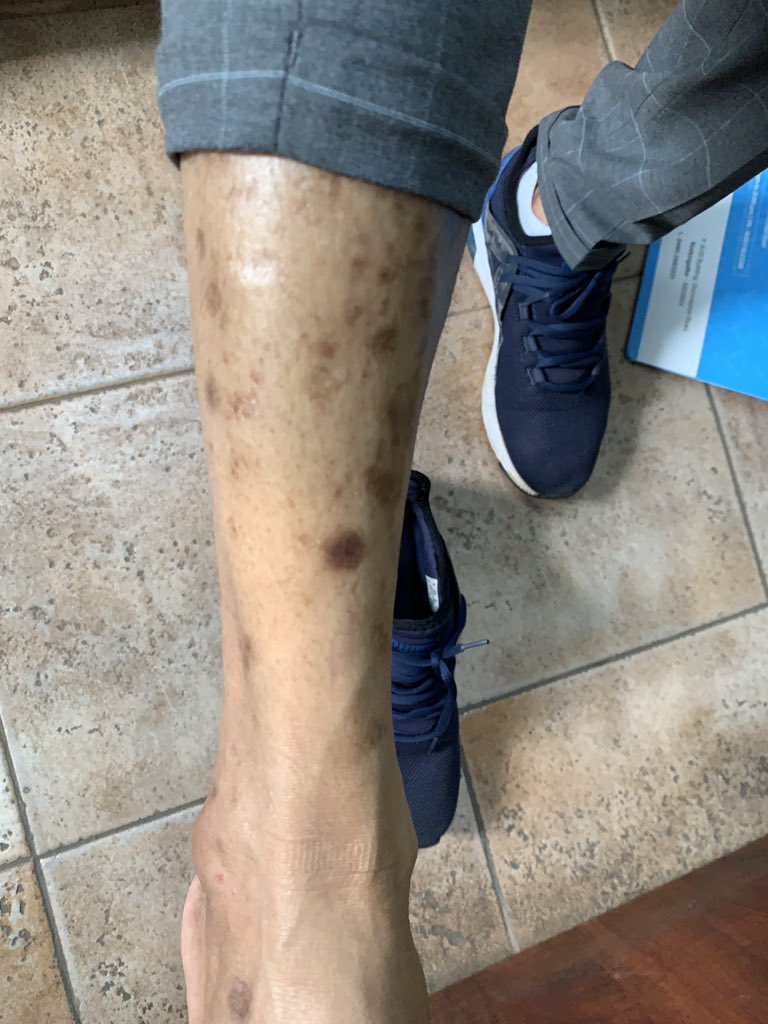 Dermopathy On Legs