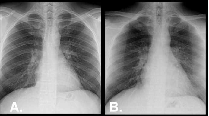 Radrounds Radiology Network On Twitter Which One Is The Pa Or Ap