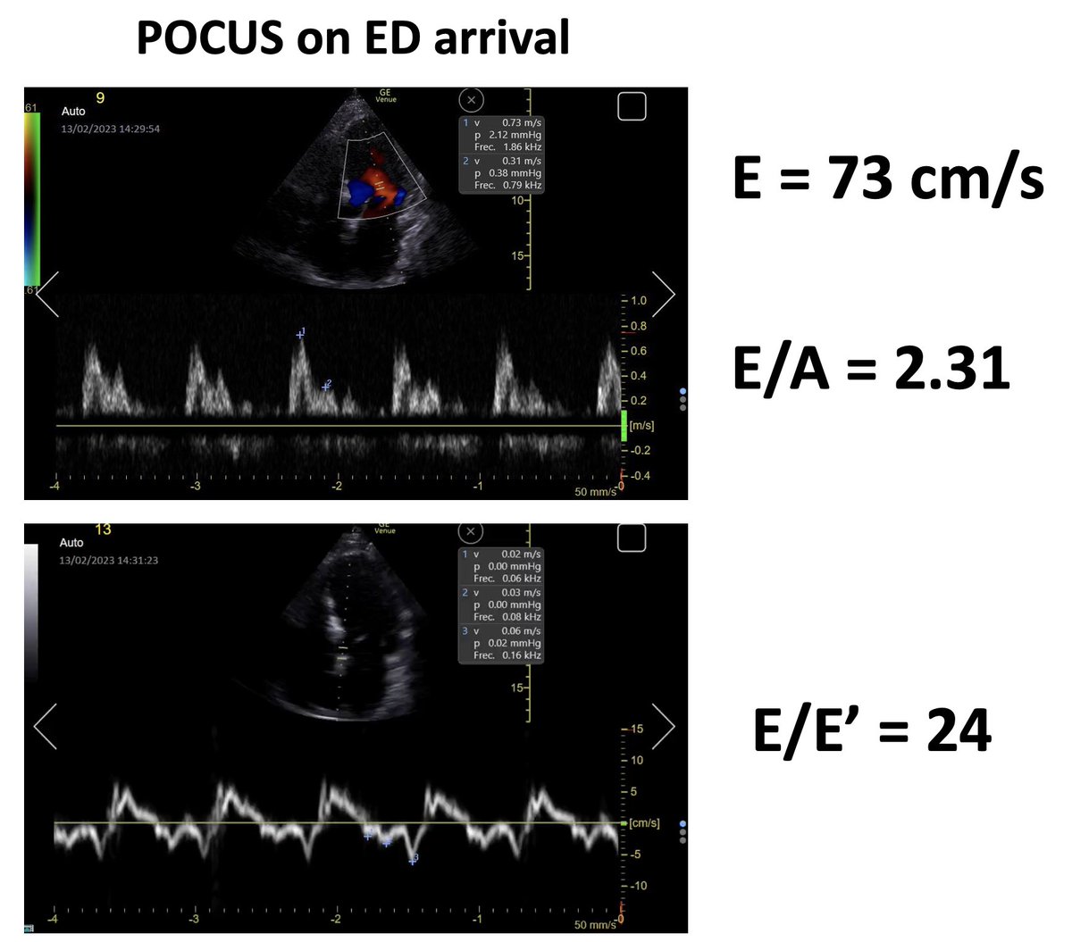 #POCUSinNephrology Beyond Lung Ultrasound (beginner level)🧵 👴 PMH: ESRD ...