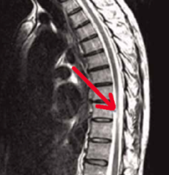 Neurosyphilis Spinal Cord