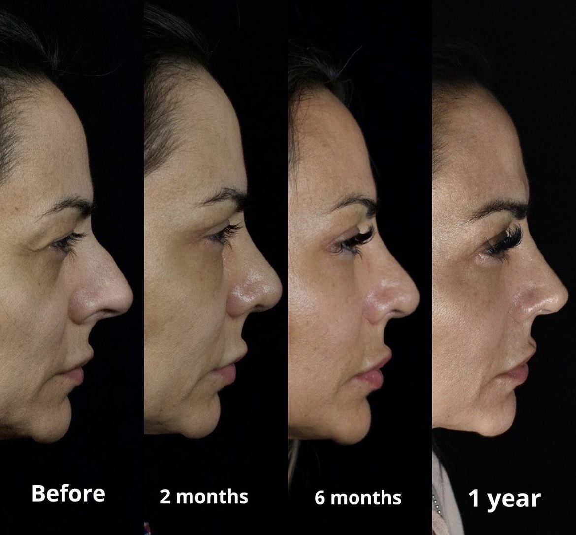 Rhinoplasty Recovery