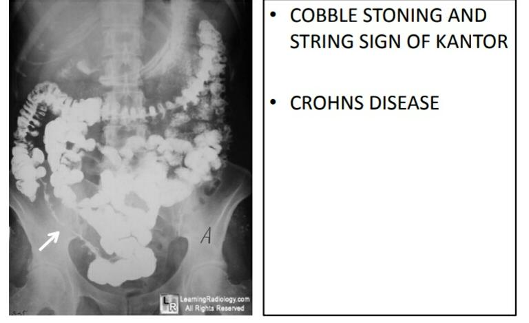 String Sign Crohns Disease