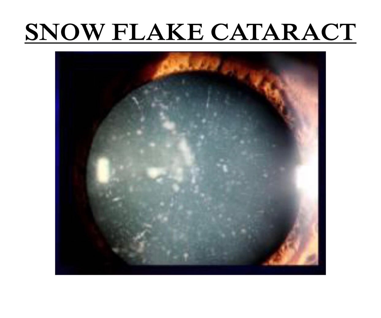 Snowflake Cataract