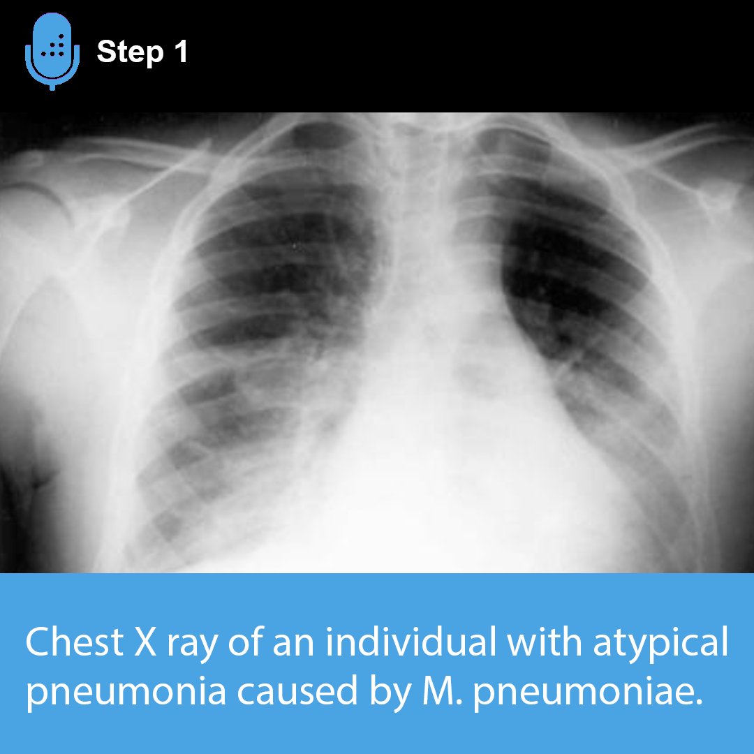 Atypical Pneumonia X Ray