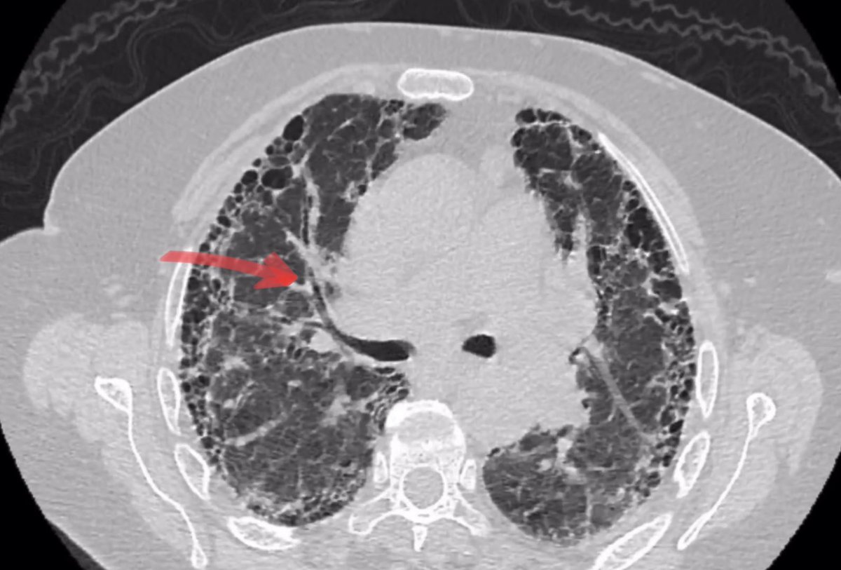 Female patient 80 years old pathologically proven typical UIP. I share ...