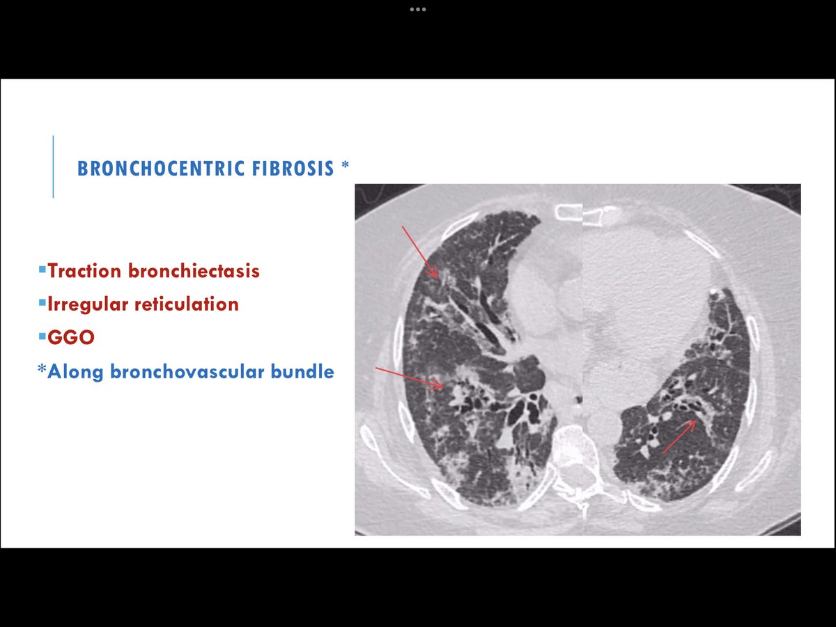 Female patient 80 years old pathologically proven typical UIP. I share ...