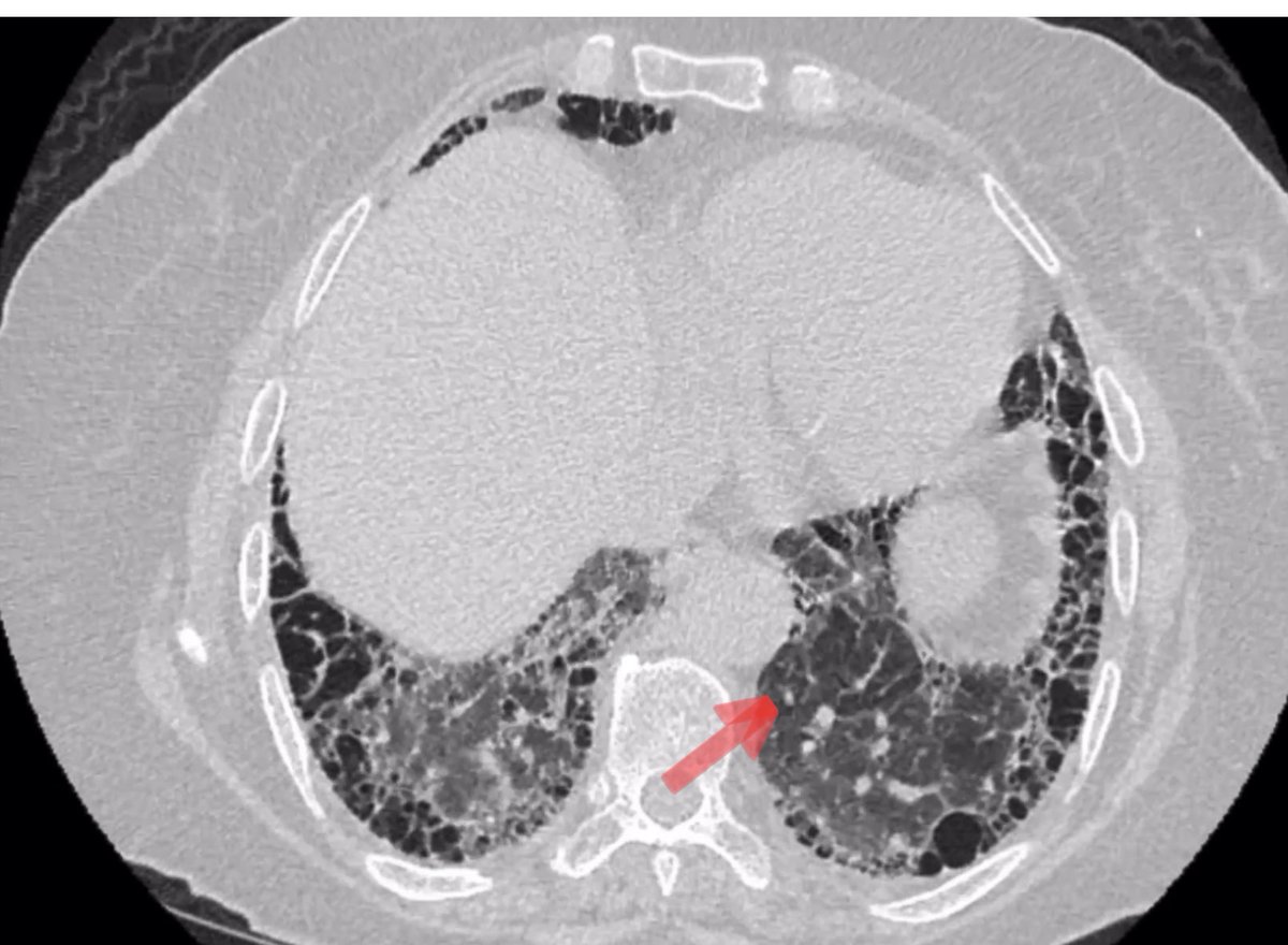 Female patient 80 years old pathologically proven typical UIP. I share ...