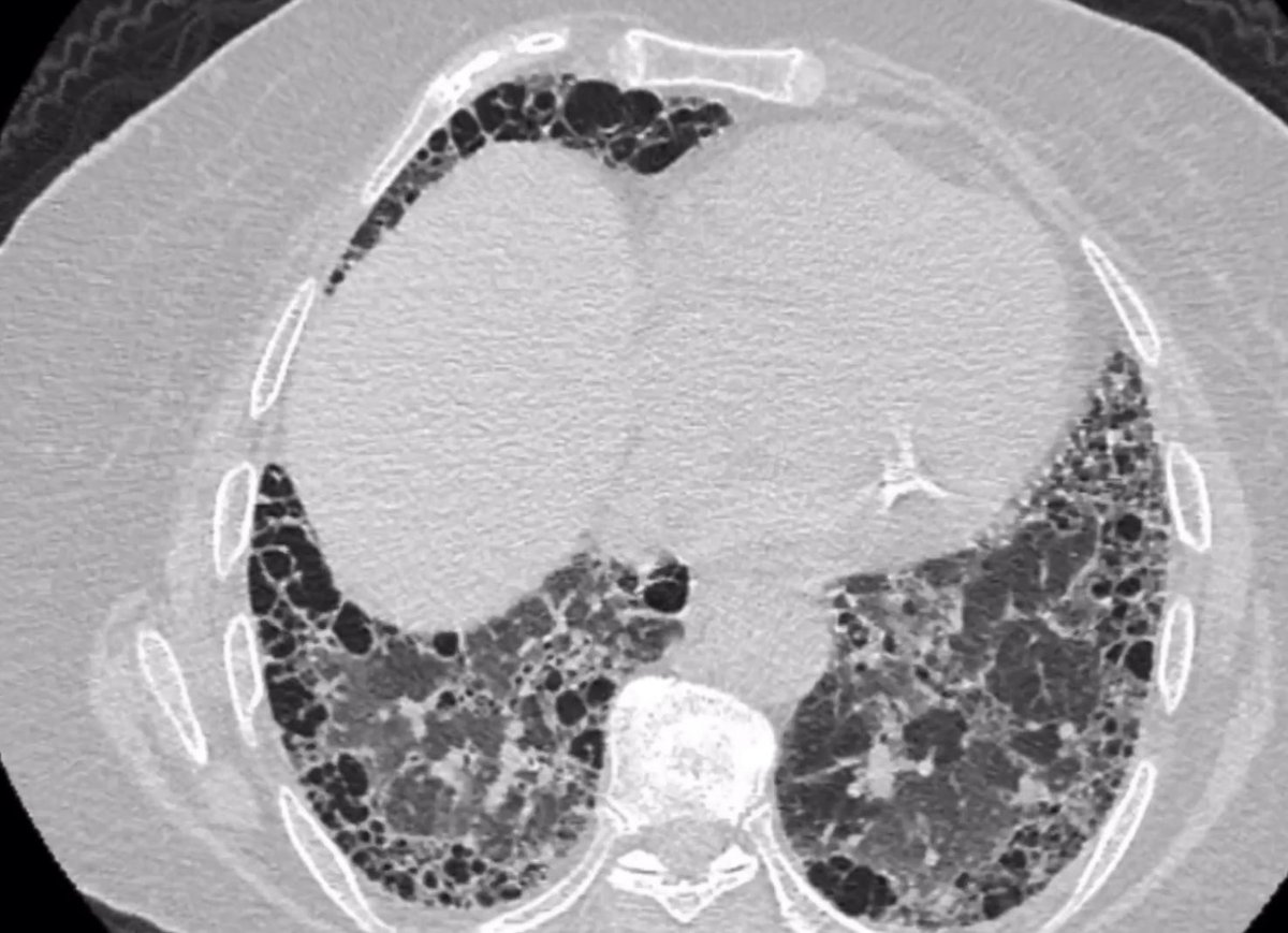 Female patient 80 years old pathologically proven typical UIP. I share ...