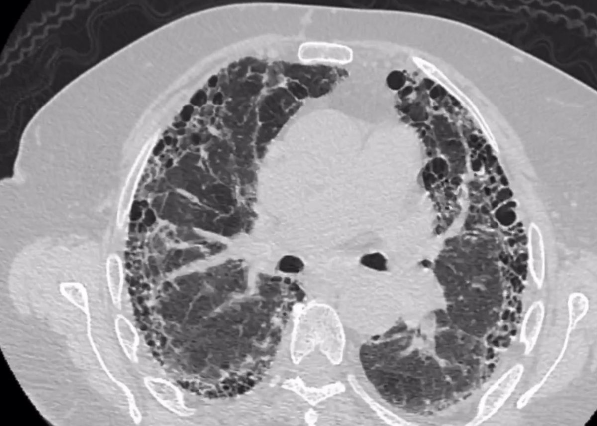 Female patient 80 years old pathologically proven typical UIP. I share ...