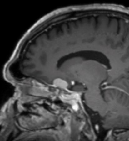 AANP on Twitter: "Secretory meningioma. 1. Ink on paper 2. MRI POST SAG MPR 3. H&E 4. PAS # ...