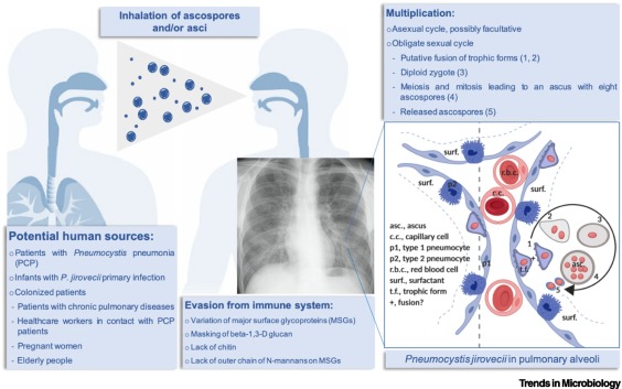 A 25-yr-old man IVDU 👉 one bout of Pneumocystis jiroveci pneumonia last ...