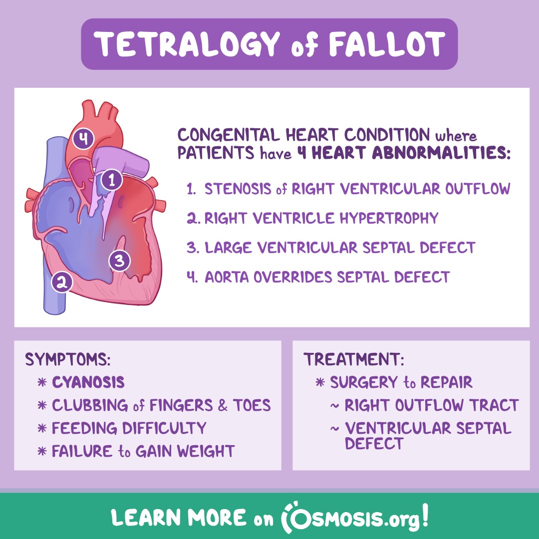 Tetralogy Of Fallot Nursing Osmosis Video Library - vrogue.co