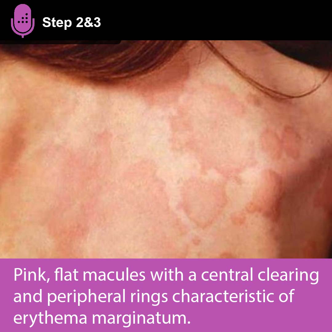 Erythema Marginatum
