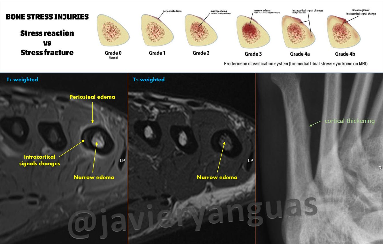 Medial Tibial Stress Syndrome Mri Medial Tibial Stress Syndrome