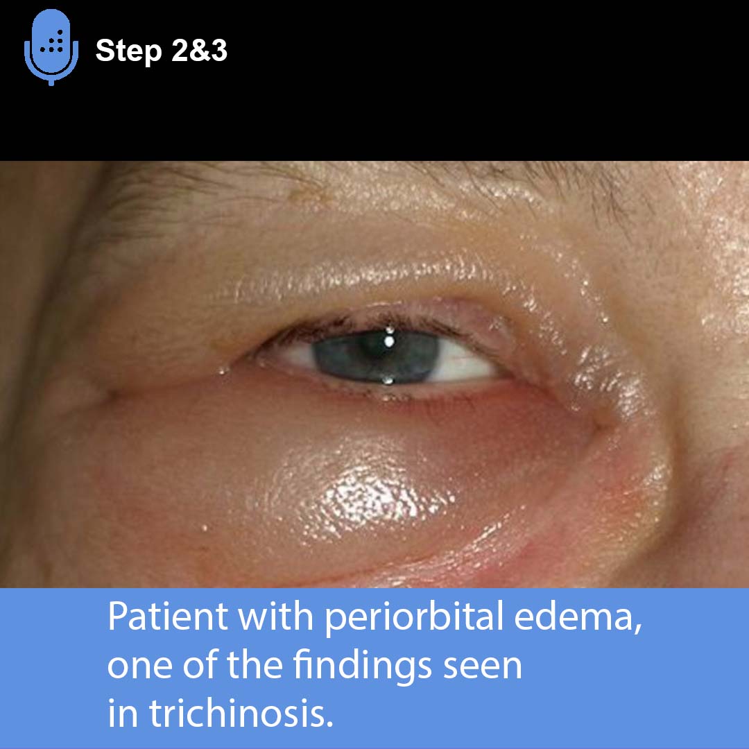 Trichinosis Causes, Prevention, Signs, Symptoms, Diagnosis,, 46% OFF