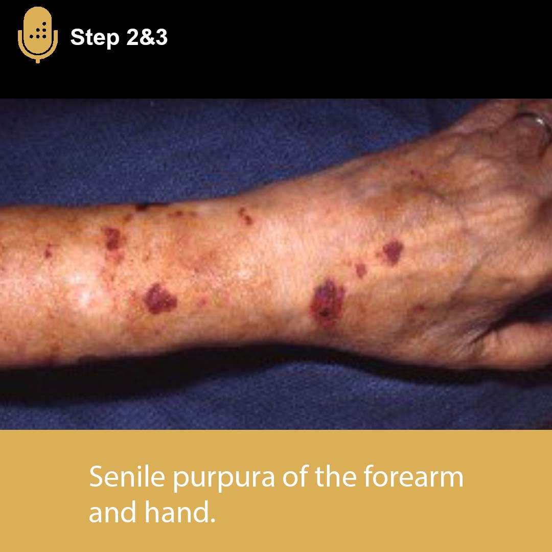 Senile Purpura
