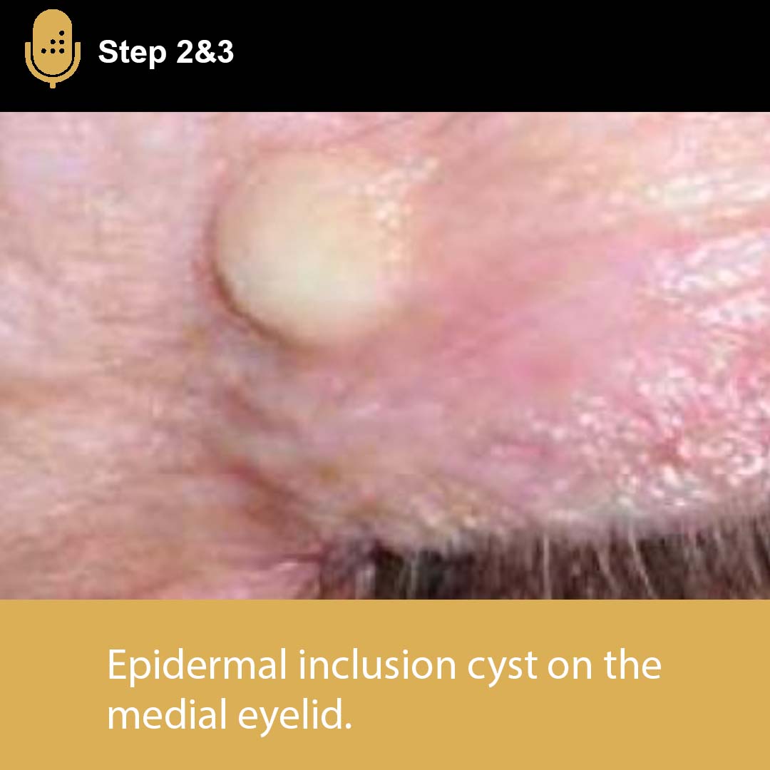 Inclusion Cysts Eyelid
