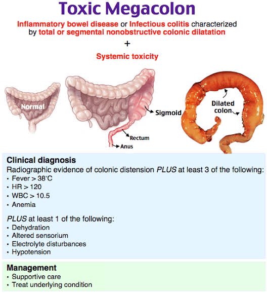 Ayman Alatas on Twitter: "Namanya Toxic Megacolon kasus ini bisa terjadi karena komplikasi ...