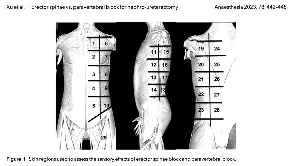 Paravertebral Block