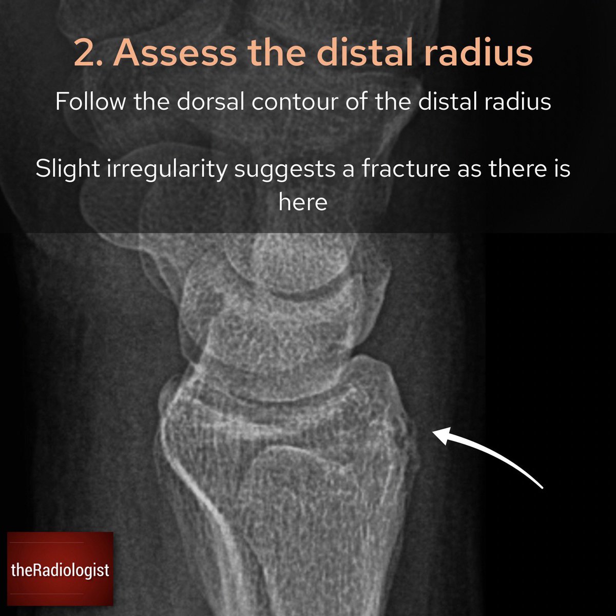 Three review areas on a lateral wrist X-Ray 🧵 - Thread from ...