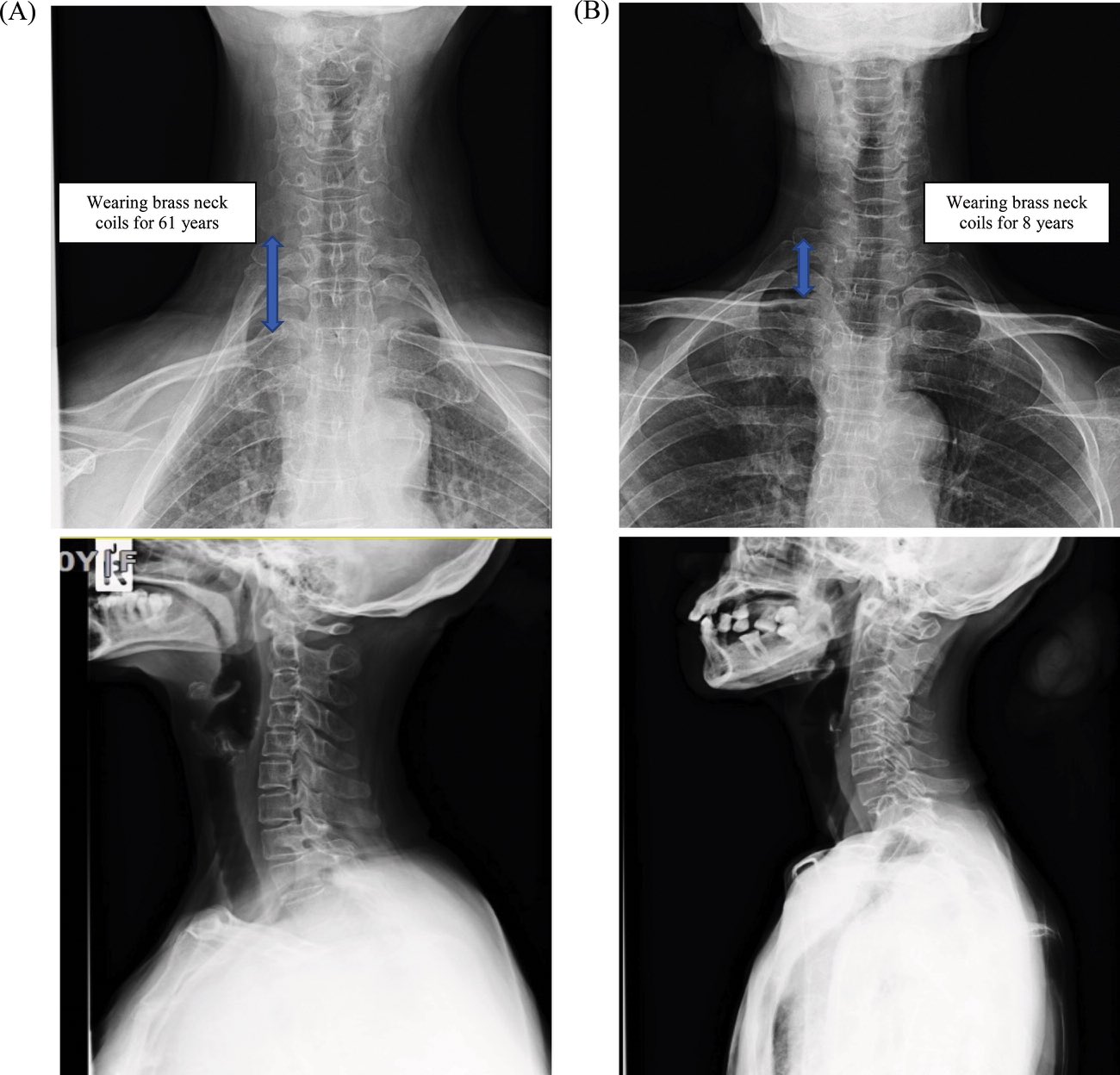 Neck Rings X Ray X Rays Of The Spine, Neck Or Back | Johns Hopkins