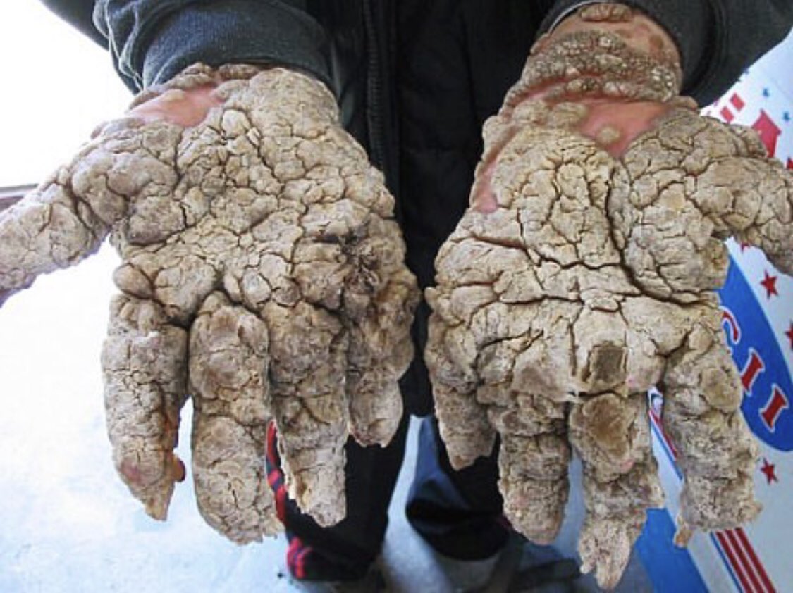 This is not a tree man leaving within us or prosthetics. This is called ...