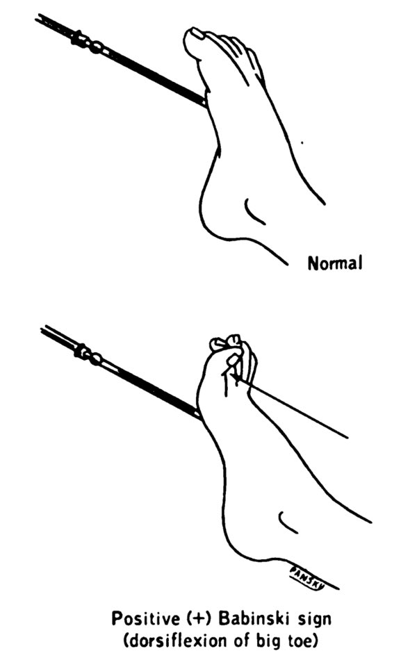 Thread on Plantar Reflex: The plantar reflex (S1-S2) is elicited when ...
