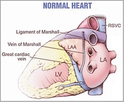 🧵Vein of Marshall. Scrubbed in my 1st #AFib ablation +Vein of Marshall ...