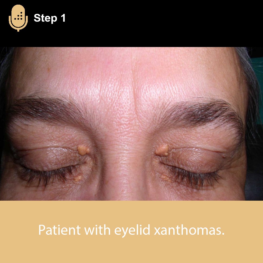 Xanthomas Eye