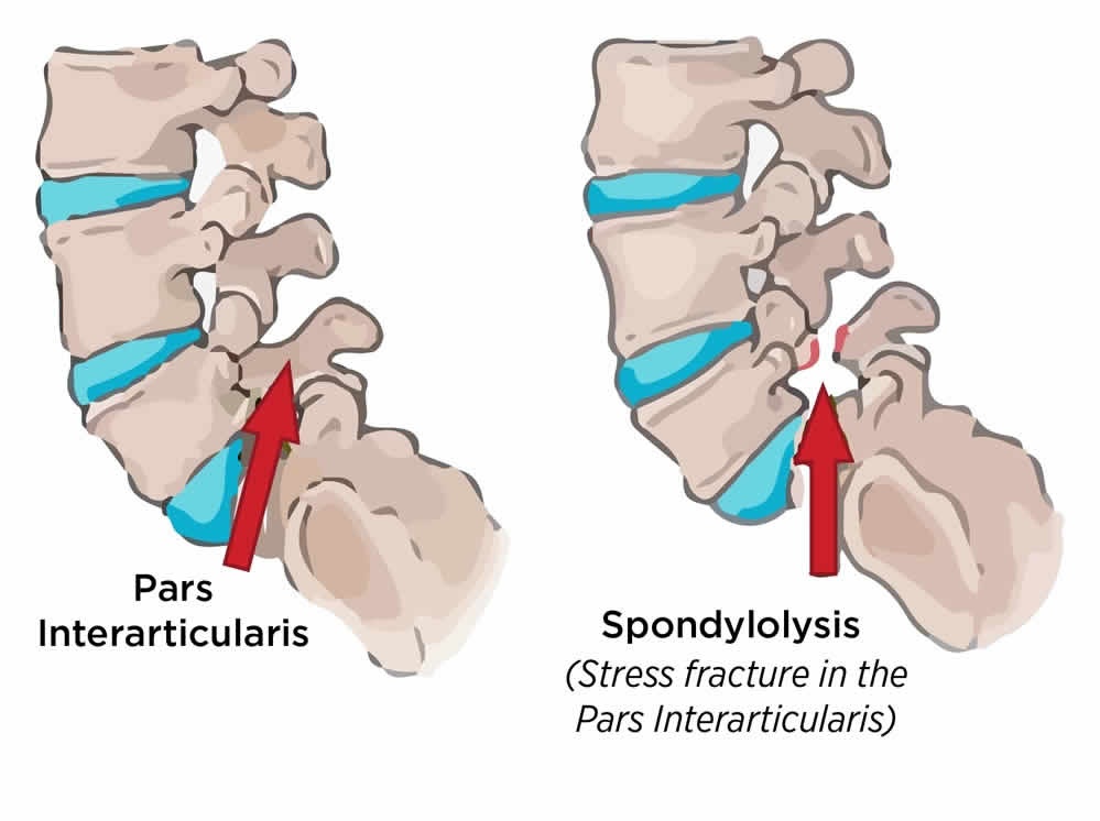 Spondy𝗹𝗼𝘀𝗶𝘀 vs Spondy𝗹𝘆𝘁𝗶𝘀 vs Spondy𝗹𝗼𝗹𝘆𝘀𝗶𝘀 vs Spondy𝗹𝗼𝗹𝘆𝘀𝘁𝗵𝗲𝘀𝗶𝘀 vs ...