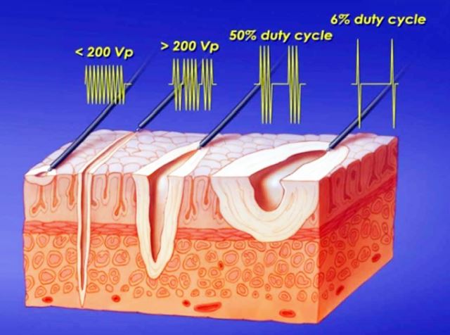 🧵regarding the CUT and COAG modes of the device commonly referred to as ...