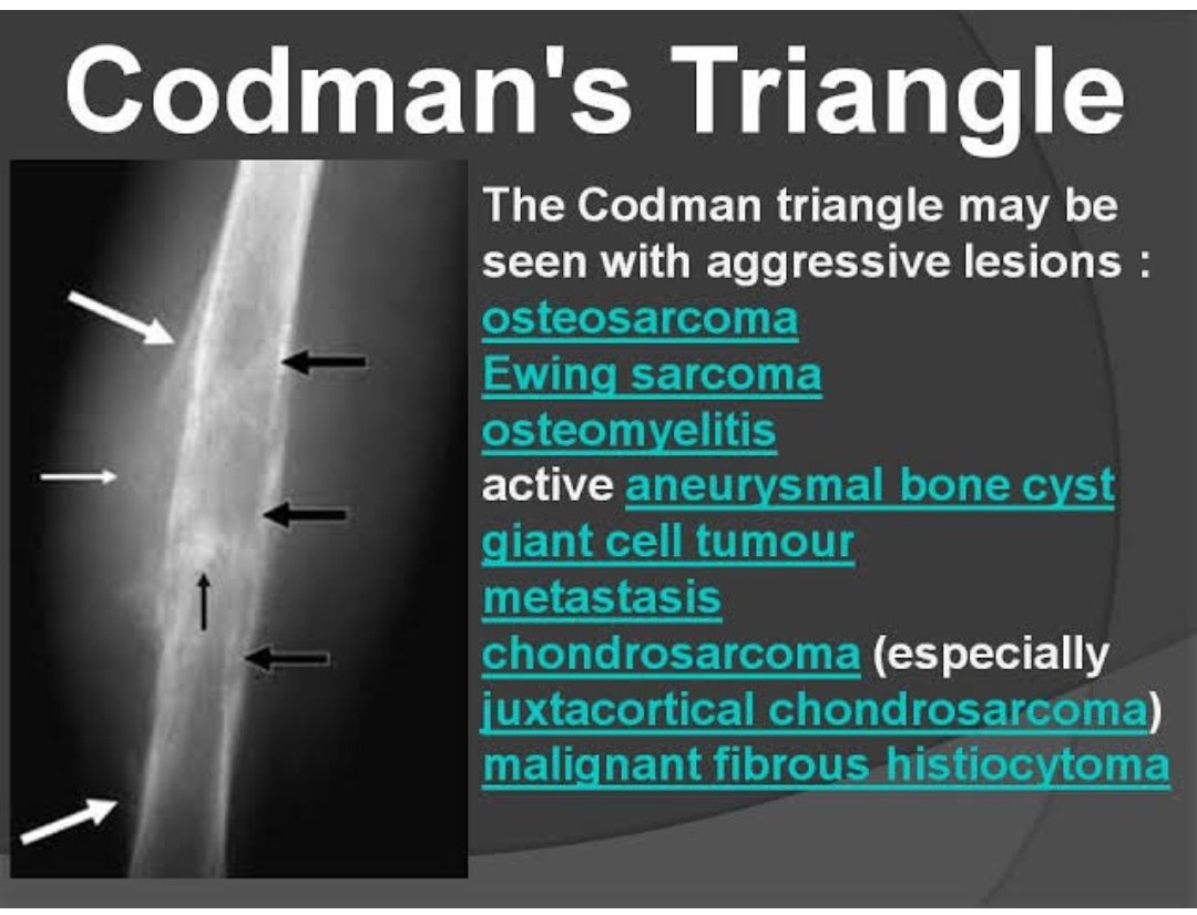 Codmans Triangle