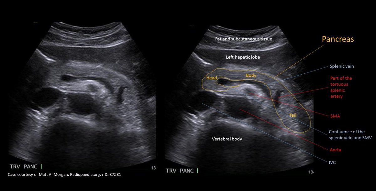 Pancreas Anatomy Ultrasound
