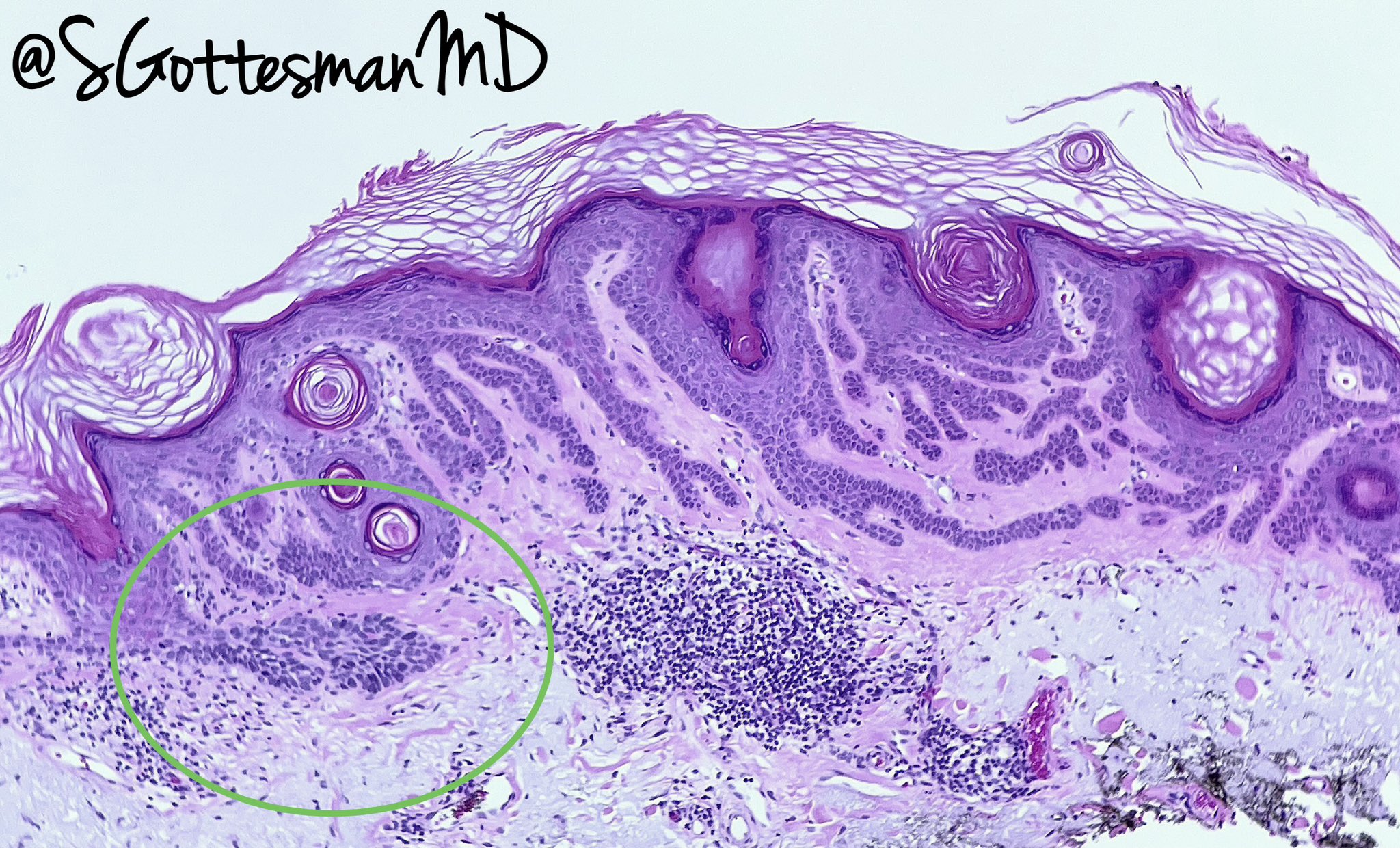 Seborrheic Keratosis Histology