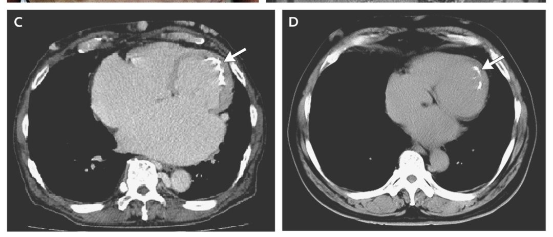 What is the diagnosis? Chronic aortic dissection Cirrhosis Hypoplastic ...