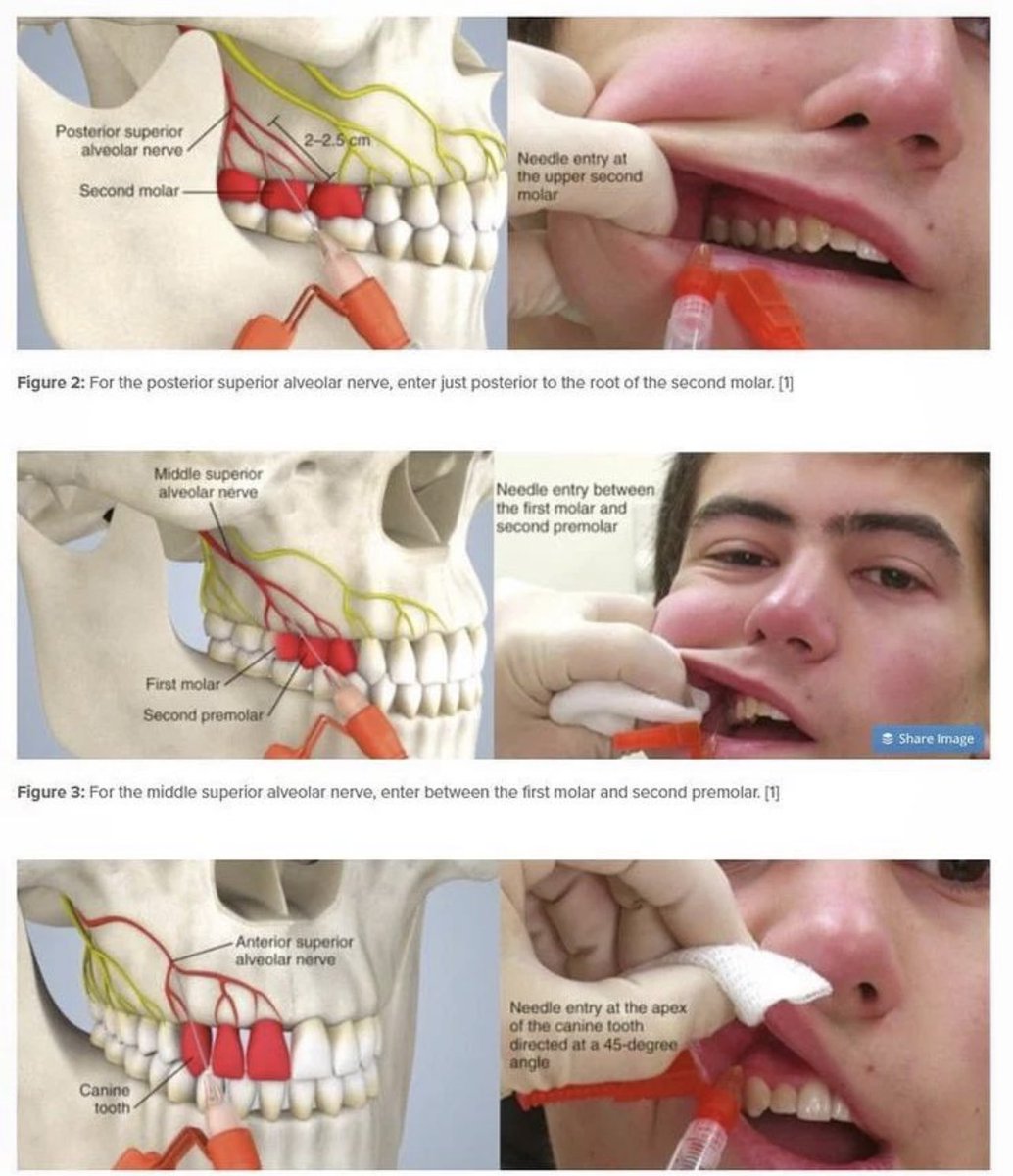 Posterior Superior Alveolar Injection Posterior Superior Alveolar