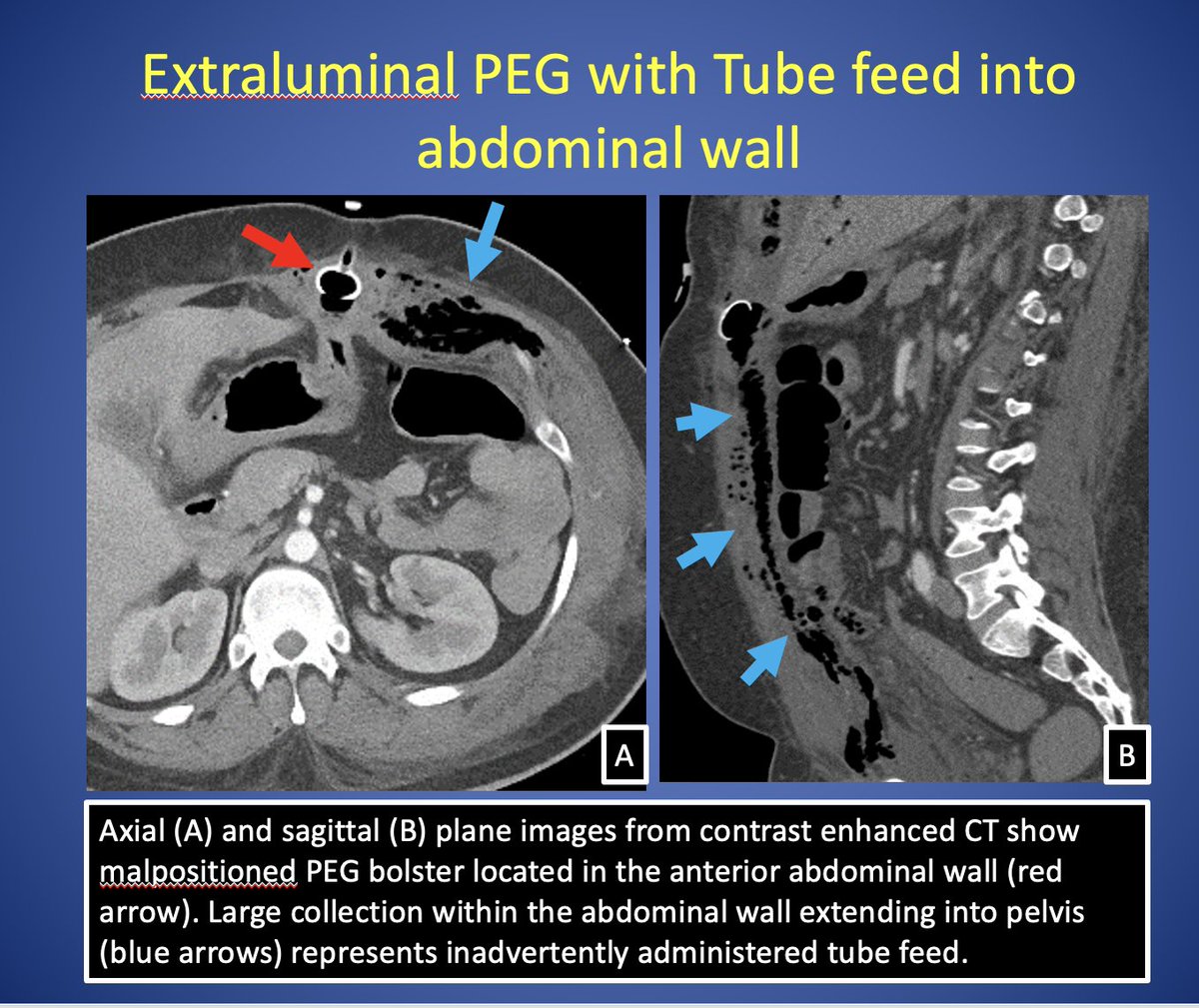 Feeding Tube Placement Percutaneous Endoscopic Gastrostomy Peg | Hot ... Feeding Tube Placement Percutaneous Endoscopic Gastrostomy Peg | Hot ...
