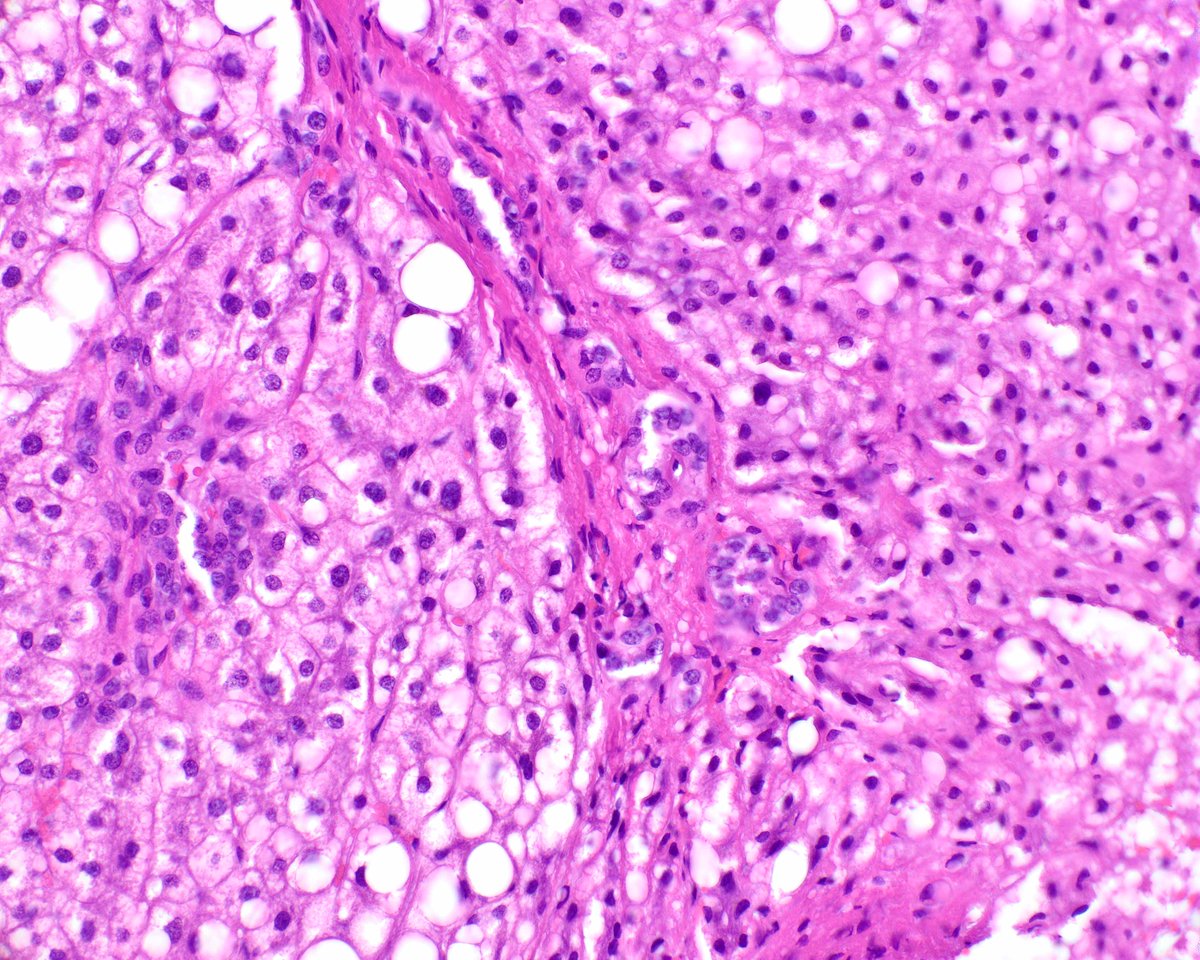 Focal Nodular Hyperplasia Pathology Outlines